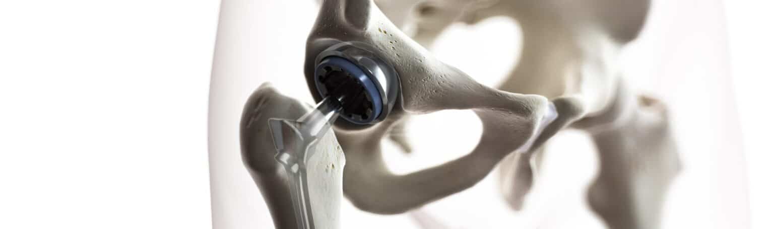 Prothèse de hanche : quand la changer ? | Chirurgie orthopédique | Paris