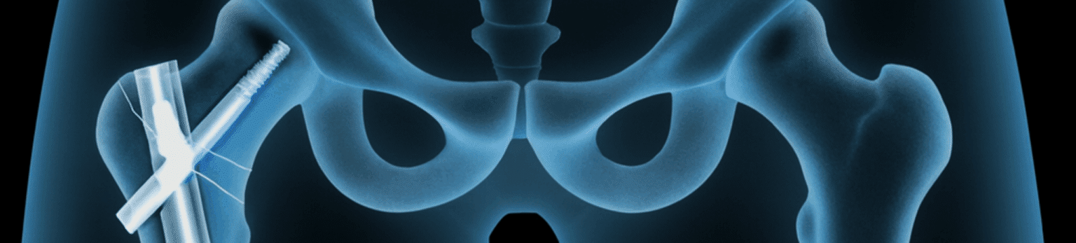 Clou Gamma : opération, mouvements interdits, rééducation, ablation et ...