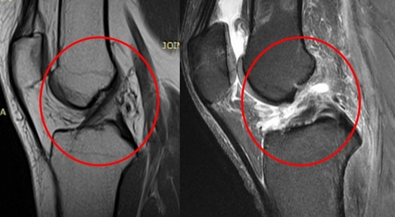 Rupture ligament croisé : symptômes et traitement